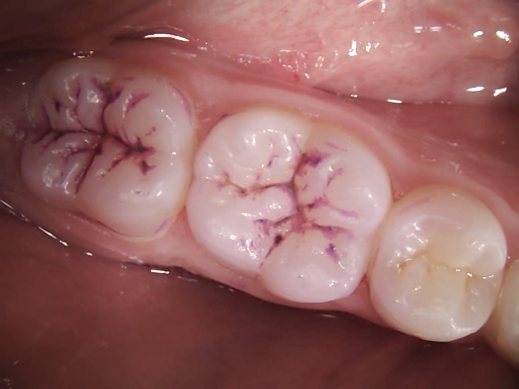 Preventing decay with fissure sealants | Jacaranda dental